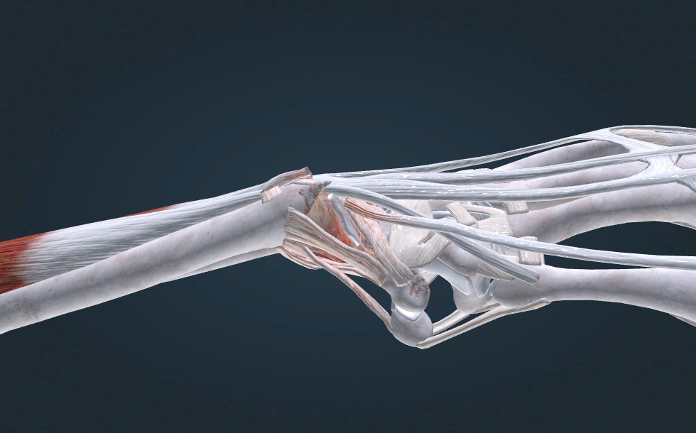 Caput ulnae syndrome - 3D сценa - BG Електронно обучение и учене Mozaik